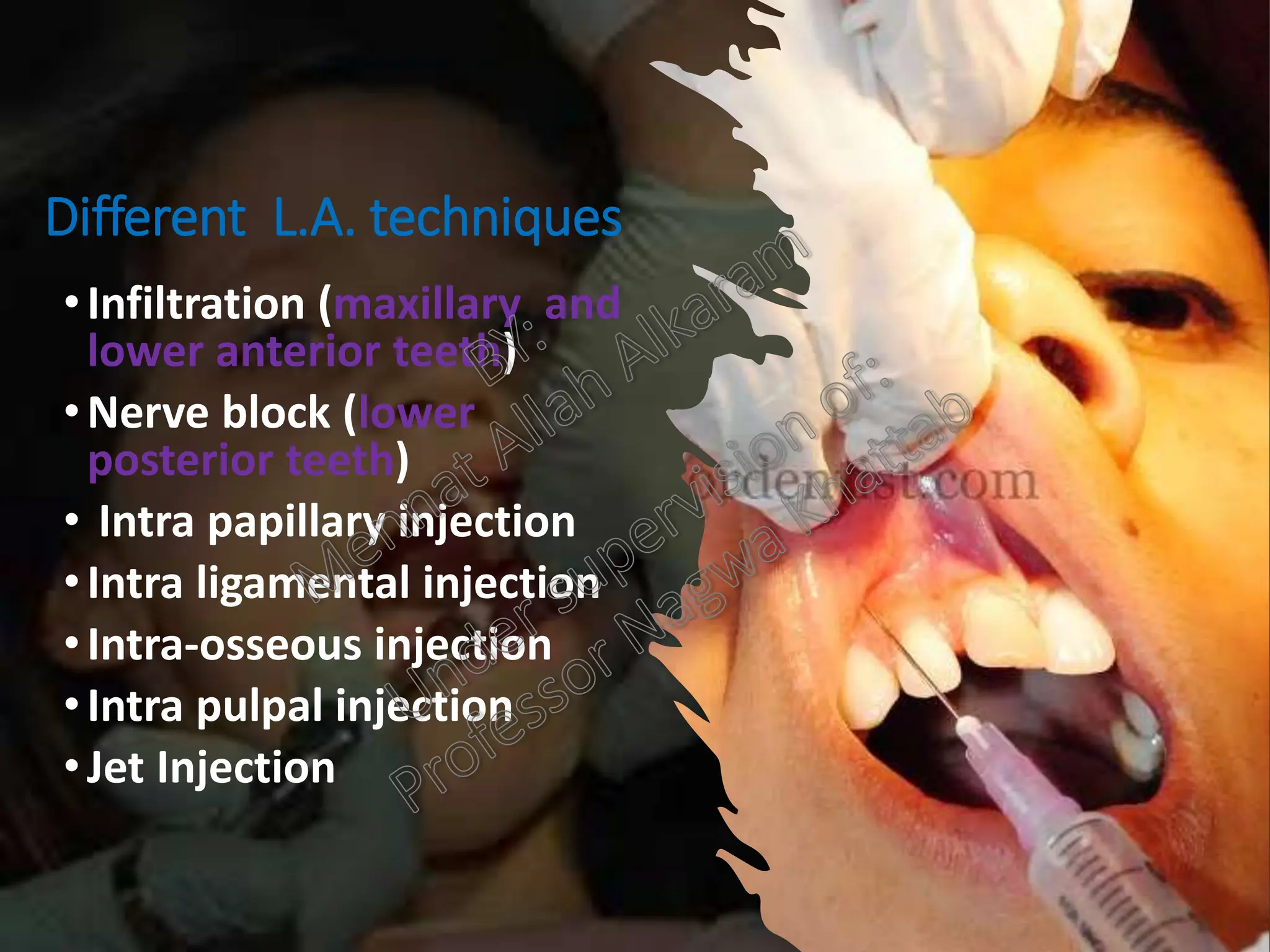 Local Anesthetic techniques for child dental patient.pptx
