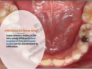 Local Anesthetic techniques for child dental patient.pptx