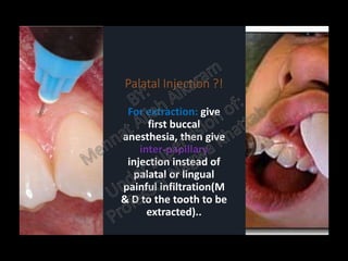 Local Anesthetic techniques for child dental patient.pptx