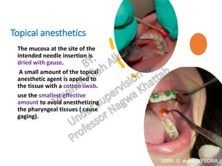 Local Anesthetic techniques for child dental patient.pptx