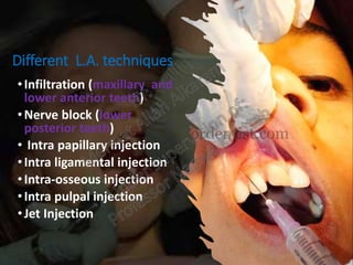 Local Anesthetic techniques for child dental patient.pptx