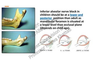 Local Anesthetic Techniques For Child Dental Patient pptx local-anesthetic-techniques-for-child-dental-patient-pptx