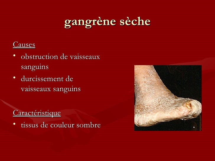 Gangrène : Signes D’une Nécrose, Causes, Traitements – Sfostsee