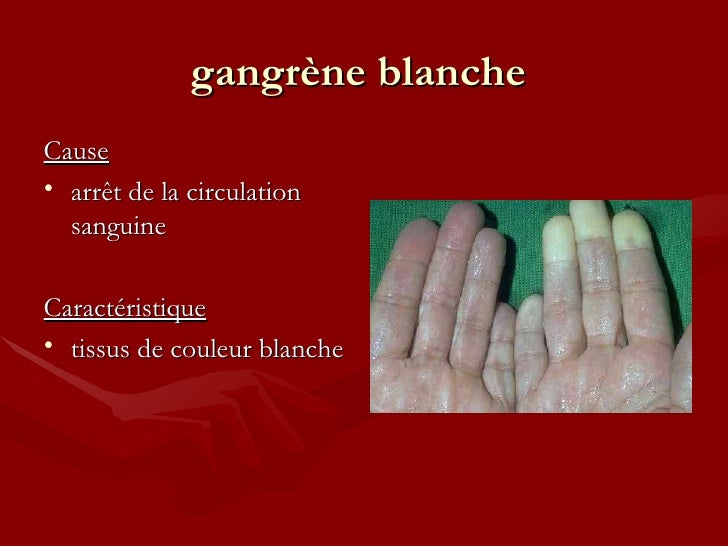 Comment Se Débarrasser D’Une Gangrène – CREM