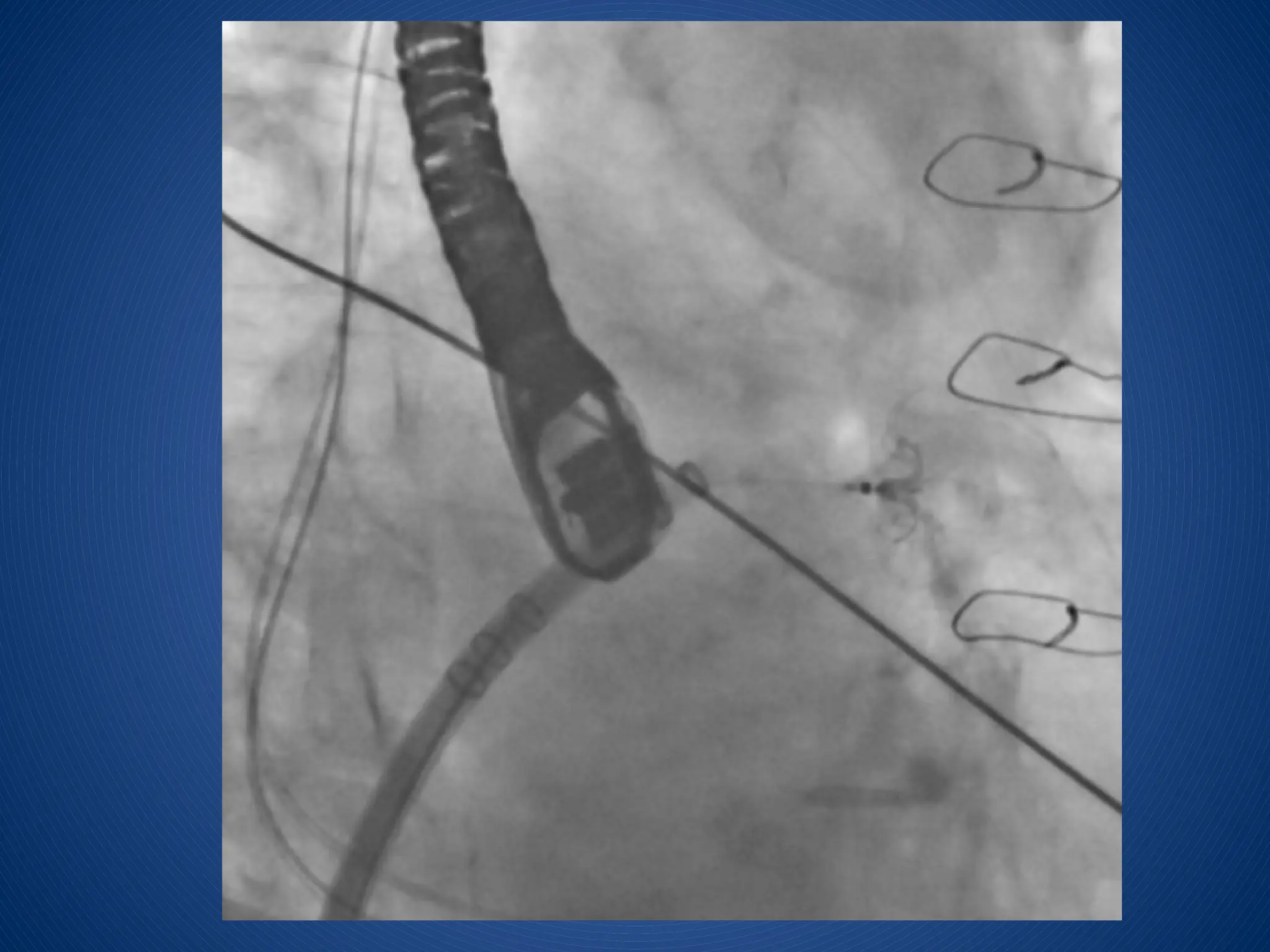 left atrial appendage closure with watchman device | PPTX
