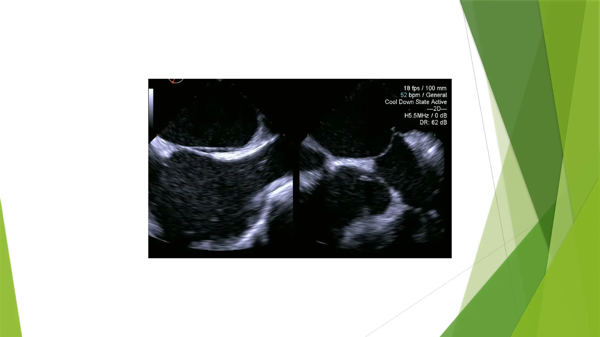Left Atrial Appendage Closure Watchman step by step.pptx
