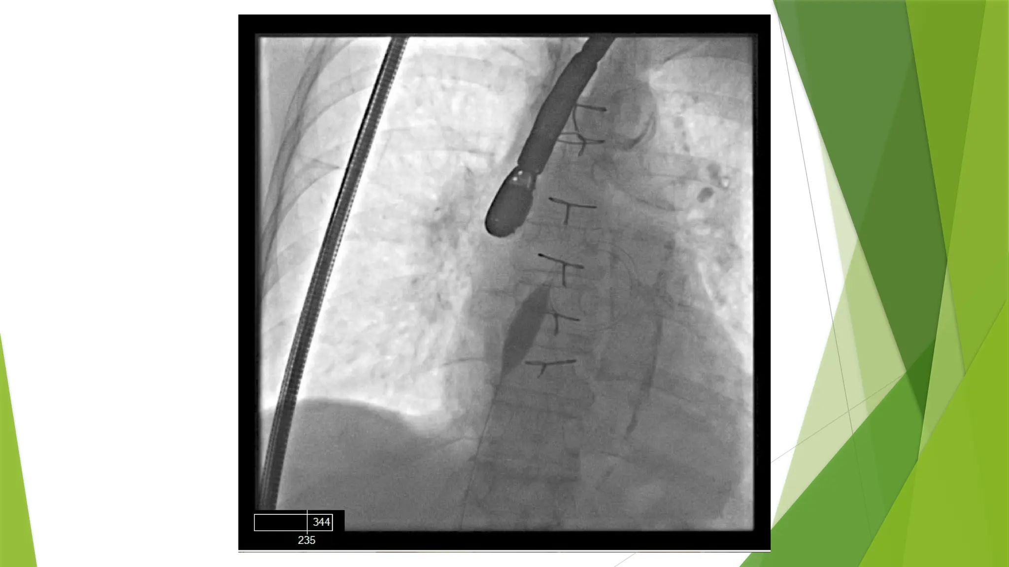 Left Atrial Appendage Closure Watchman step by step.pptx
