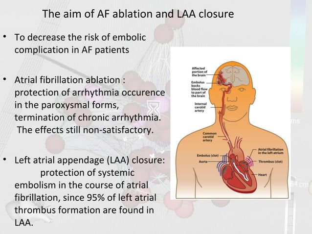 LAA ligation and ablation - dr Marcin Kuniewicz | PPT