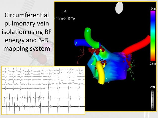 LAA ligation and ablation - dr Marcin Kuniewicz | PPT