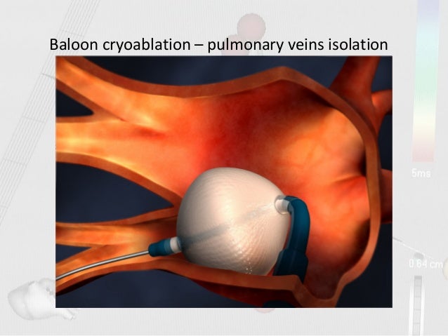 LAA ligation and ablation - dr Marcin Kuniewicz