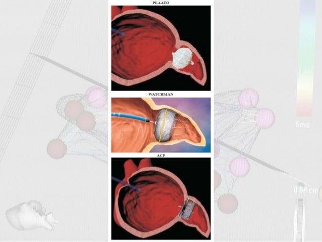 LAA ligation and ablation - dr Marcin Kuniewicz