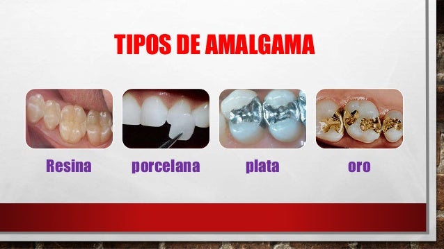 Qu Es Una Amalgama Dental Odontotecks