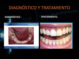 La anquilosis dental | ODP