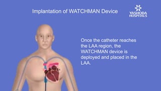 LAA Watchman | PPTX