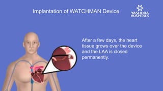 LAA Watchman | PPTX