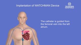 LAA Watchman | PPTX