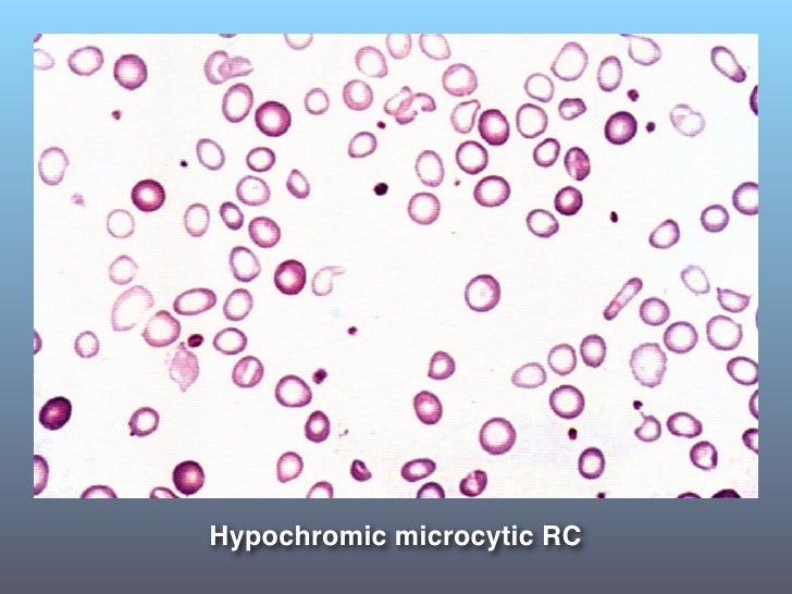 Rbc Pathology Normal Rbc Pbs Morphology Rbc Indices