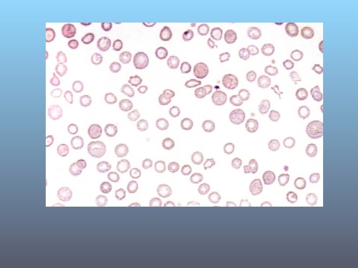 Rbc Pathology Normal Rbc Pbs Morphology Rbc Indices