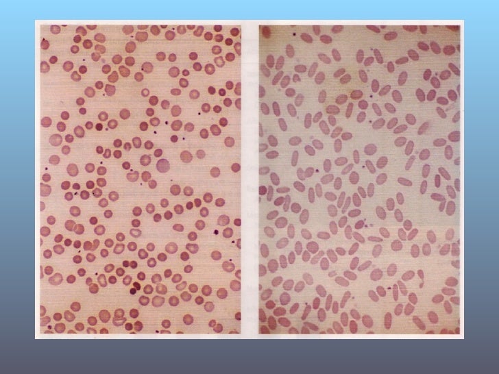 Rbc Pathology Normal Rbc Pbs Morphology Rbc Indices