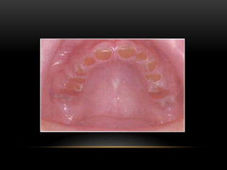 Lab 3 developmental defect teeth dina | PPTX