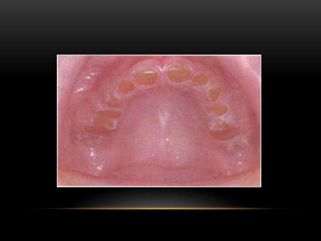 Lab 3 developmental defect teeth dina | PPT