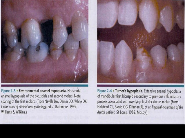 Lab 3 developmental defect teeth dina | PPT