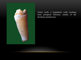 Lab 3 developmental defect teeth dina | PPTX