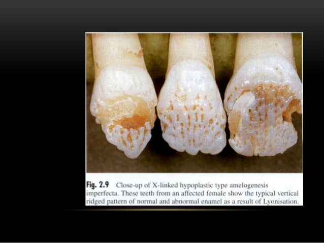 Lab 3 developmental defect teeth dina