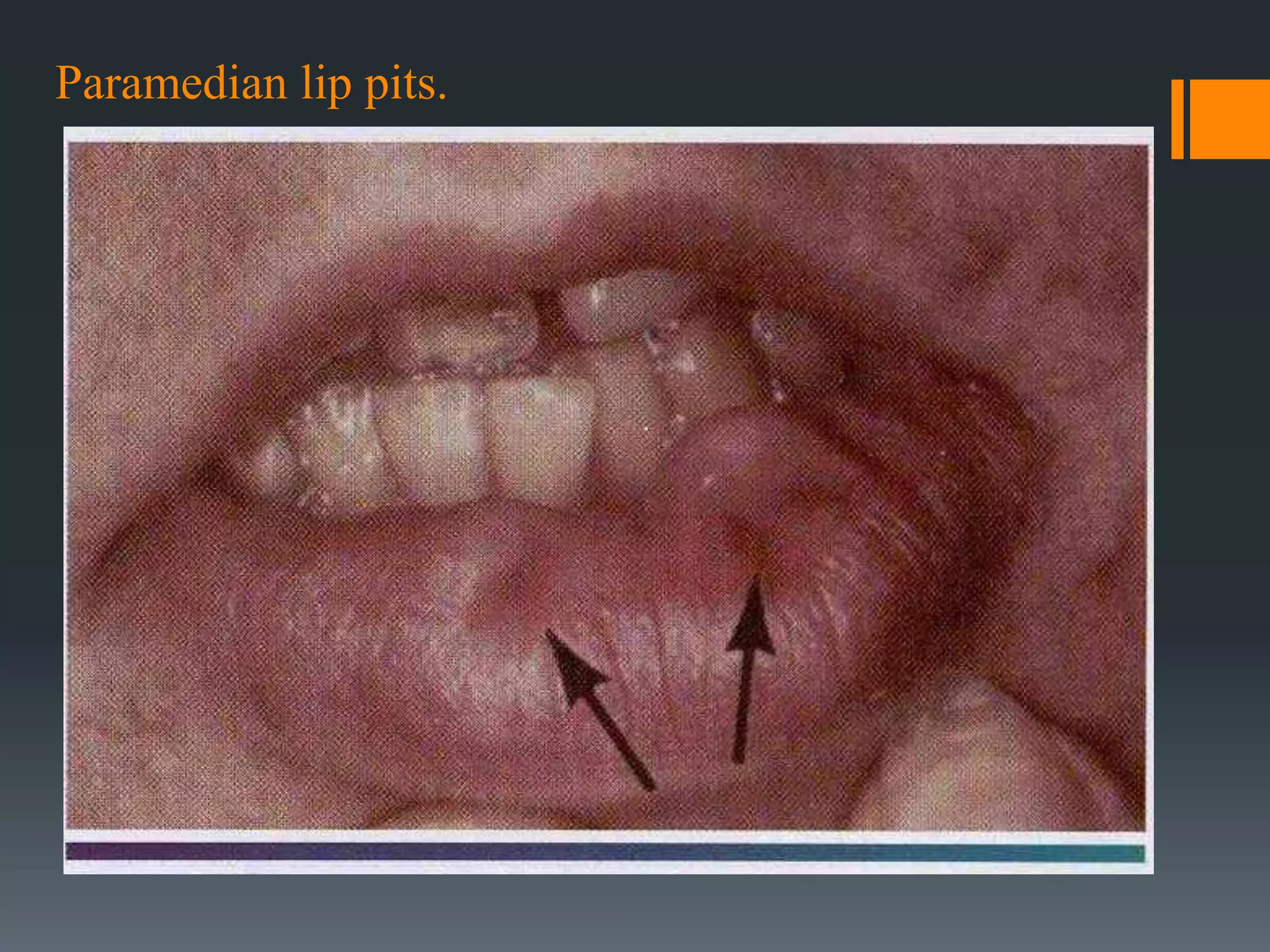 Lab 4 developmental defect soft tissue dina patho | PPTX