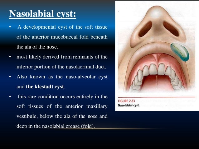 Nasolabial Cyst Symptoms