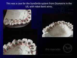 Lab communications for Lingual Orthodontics | PDF | Dental Health ...