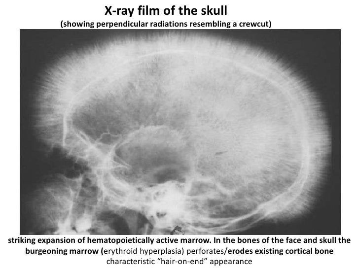 Laboratory Diagonosis thalassemia Chirantan