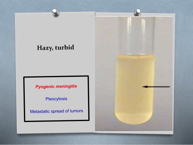 Lab diagnosis of chronic meningitis. tavr