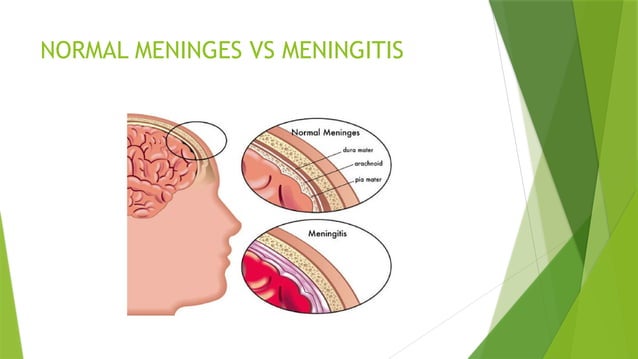 Meningitis, Types , causes ,symptoms and Diagnosis of Meningitis.pptx