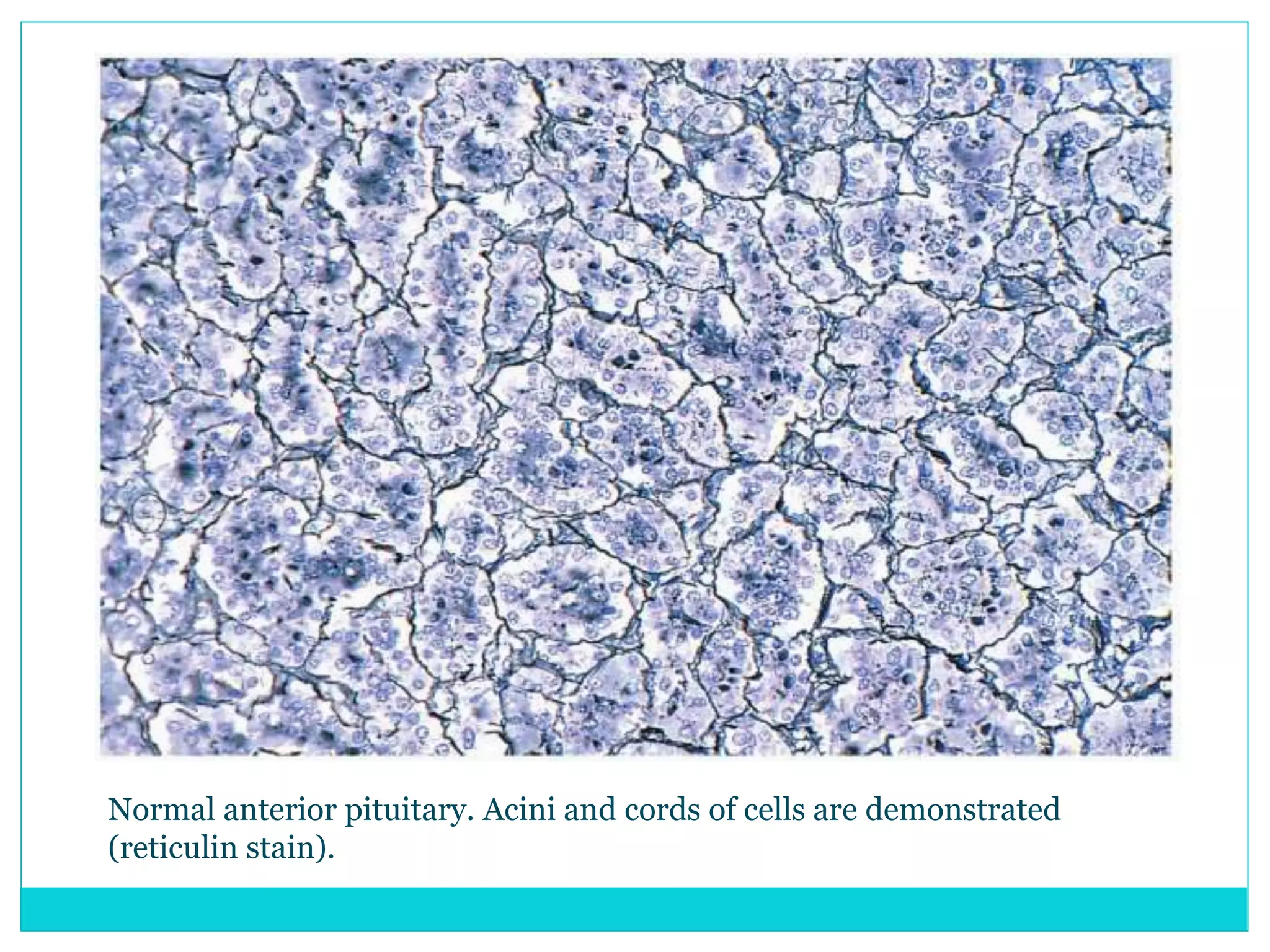 Lab diagnosis of pituitary tumors | PPTX