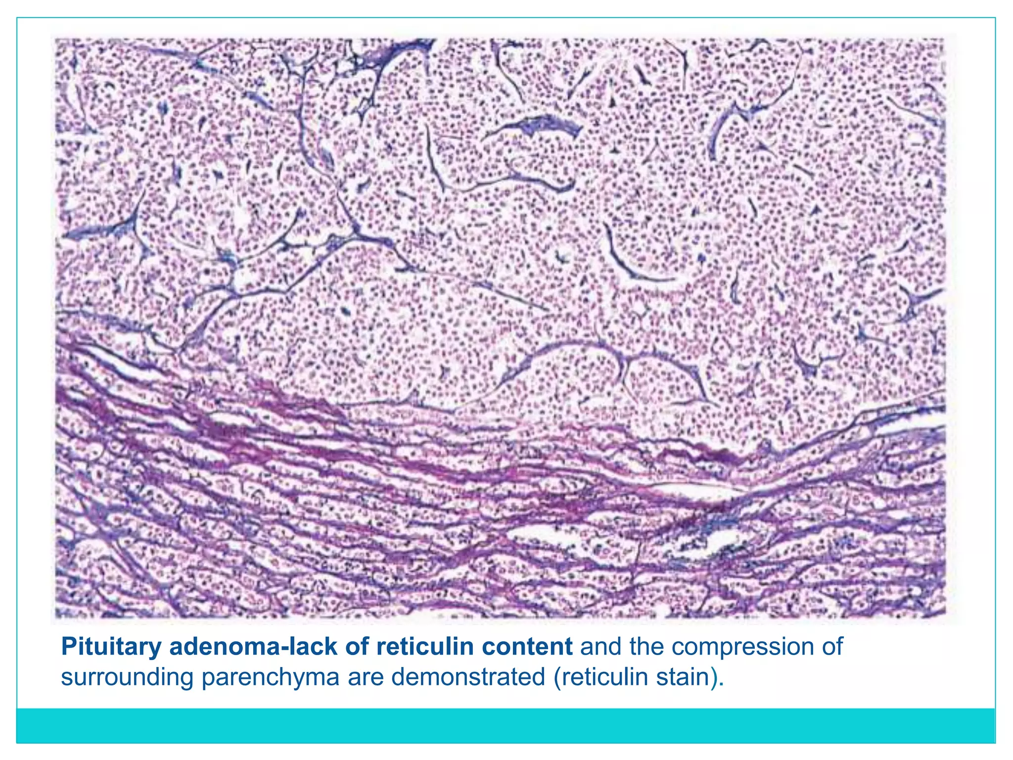 Lab diagnosis of pituitary tumors | PPTX