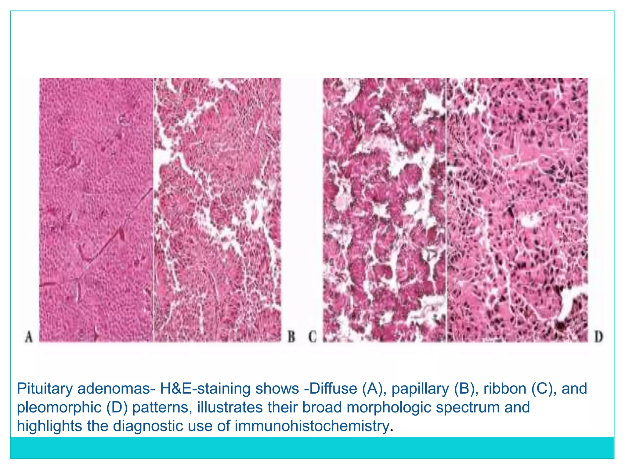 Lab diagnosis of pituitary tumors | PPTX