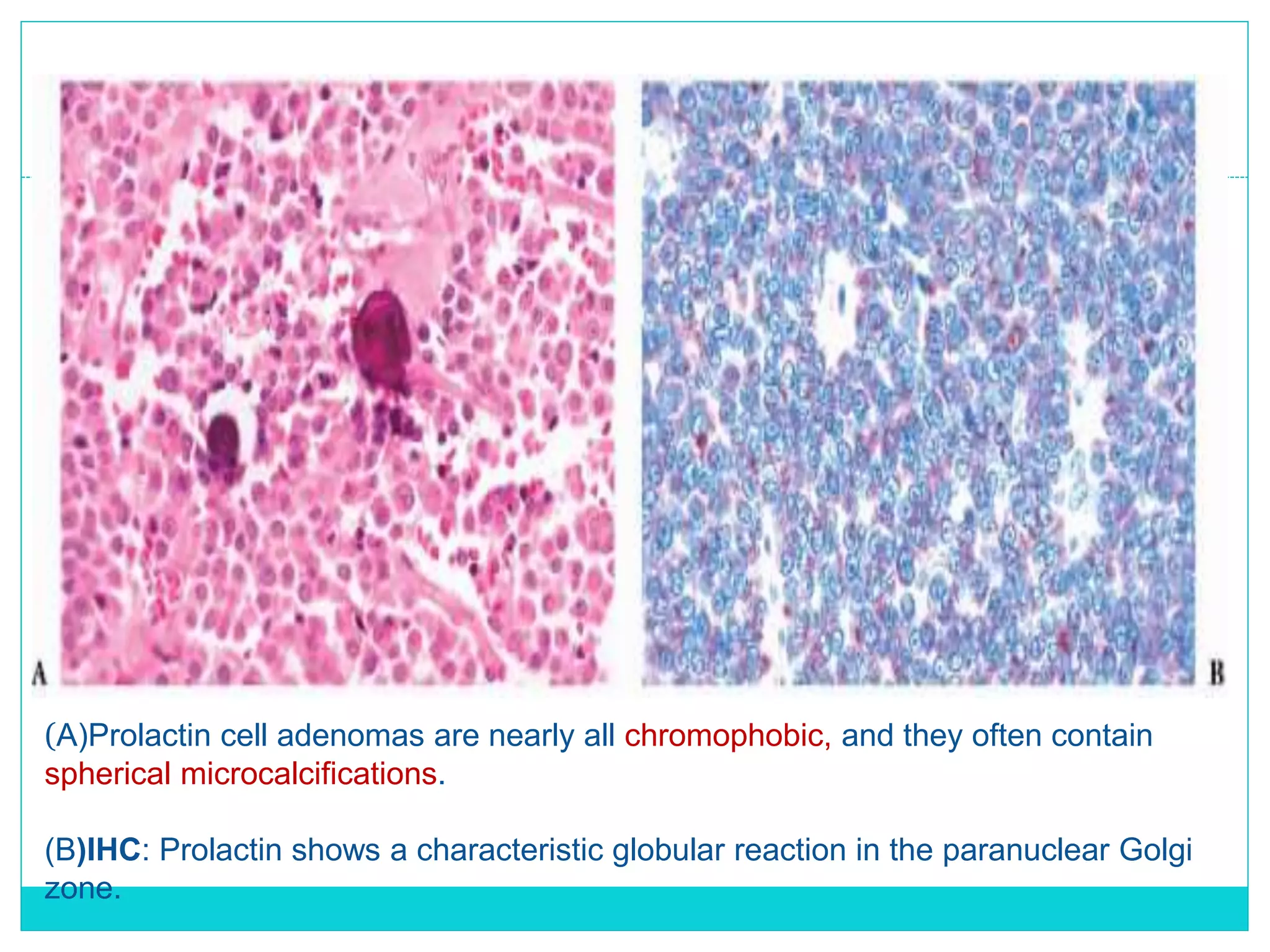 Lab diagnosis of pituitary tumors | PPTX