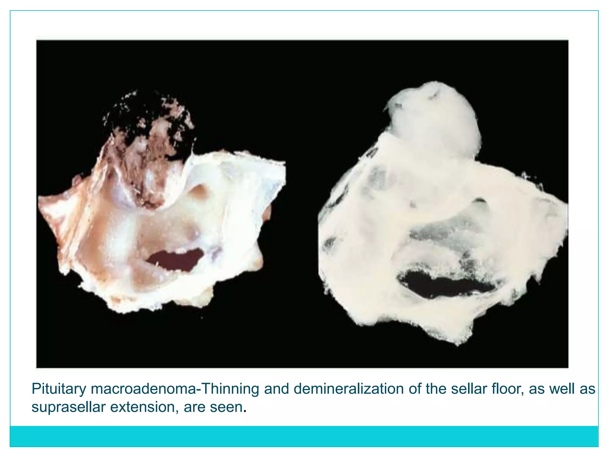 Lab diagnosis of pituitary tumors | PPTX