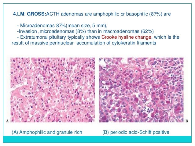 Lab diagnosis of pituitary tumors