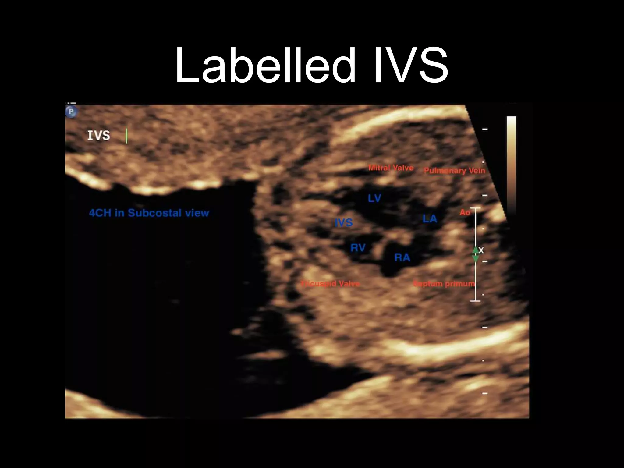 Labelled fetal heart ultrasound | PPTX