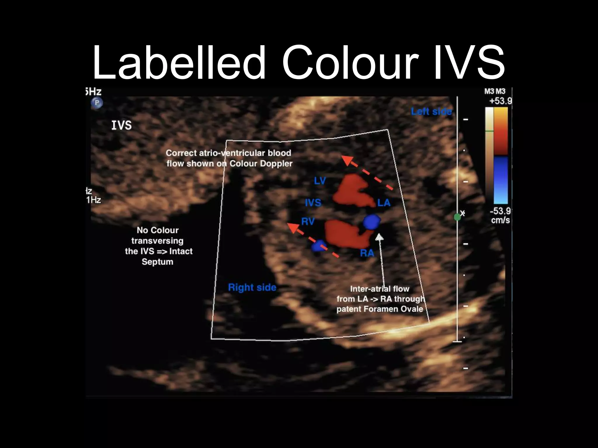 Labelled fetal heart ultrasound | PPTX