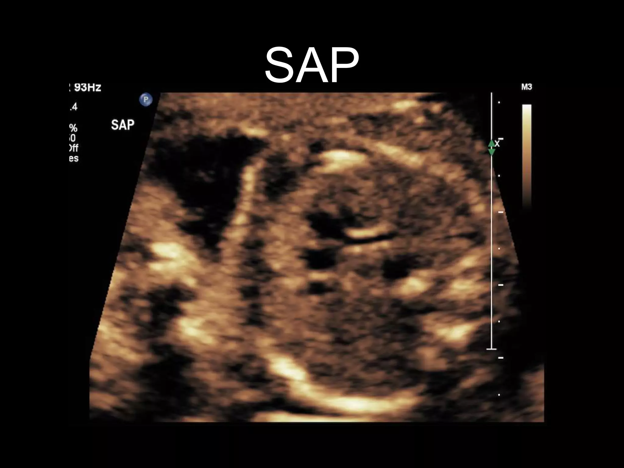 Labelled fetal heart ultrasound | PPTX
