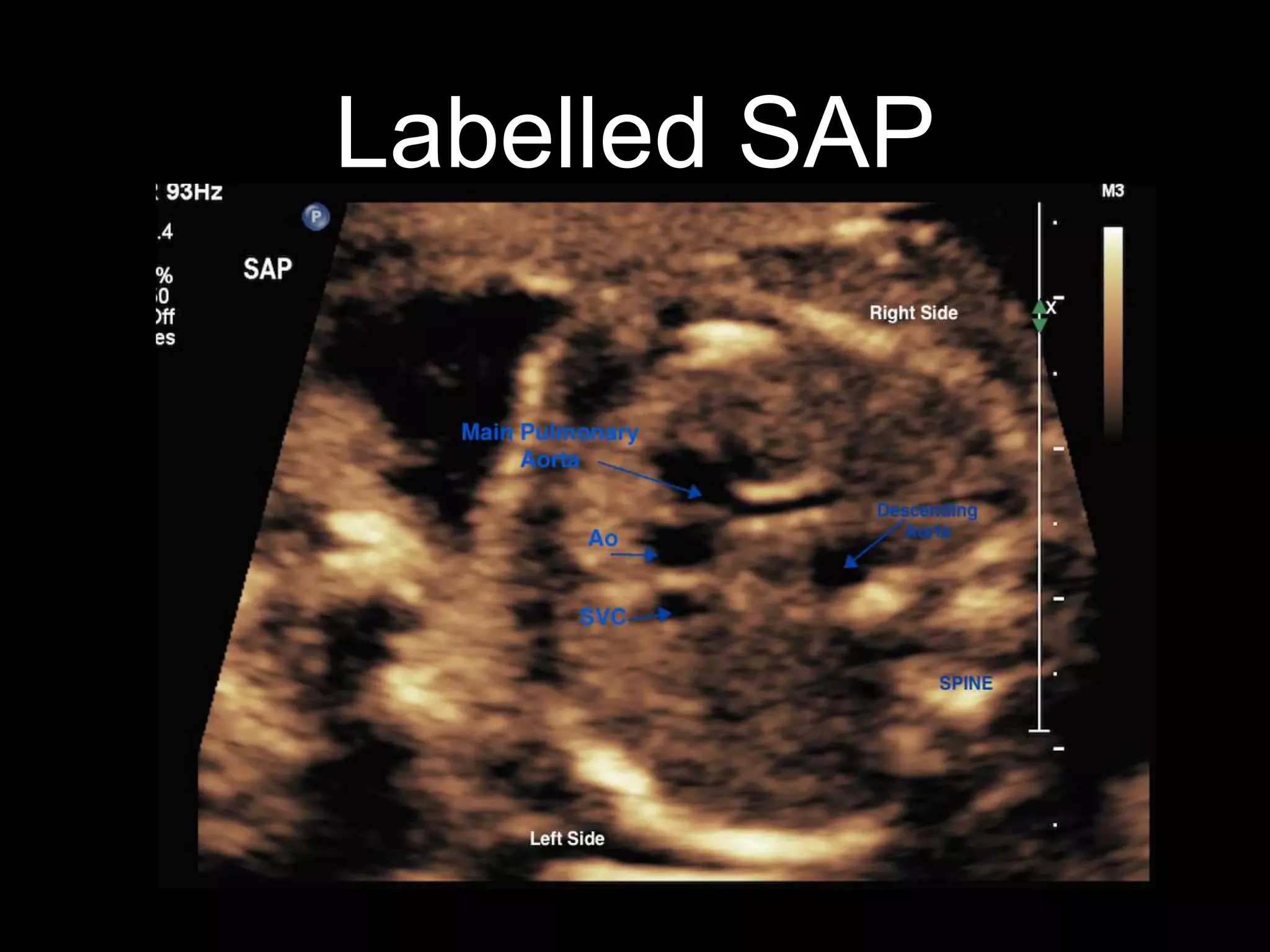 Labelled fetal heart ultrasound | PPTX