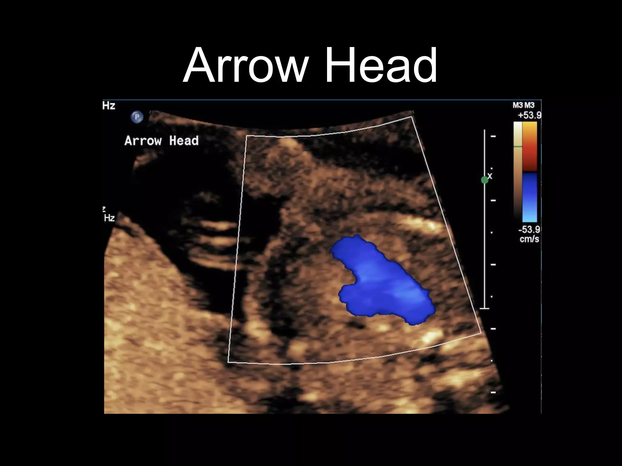 Labelled fetal heart ultrasound | PPTX
