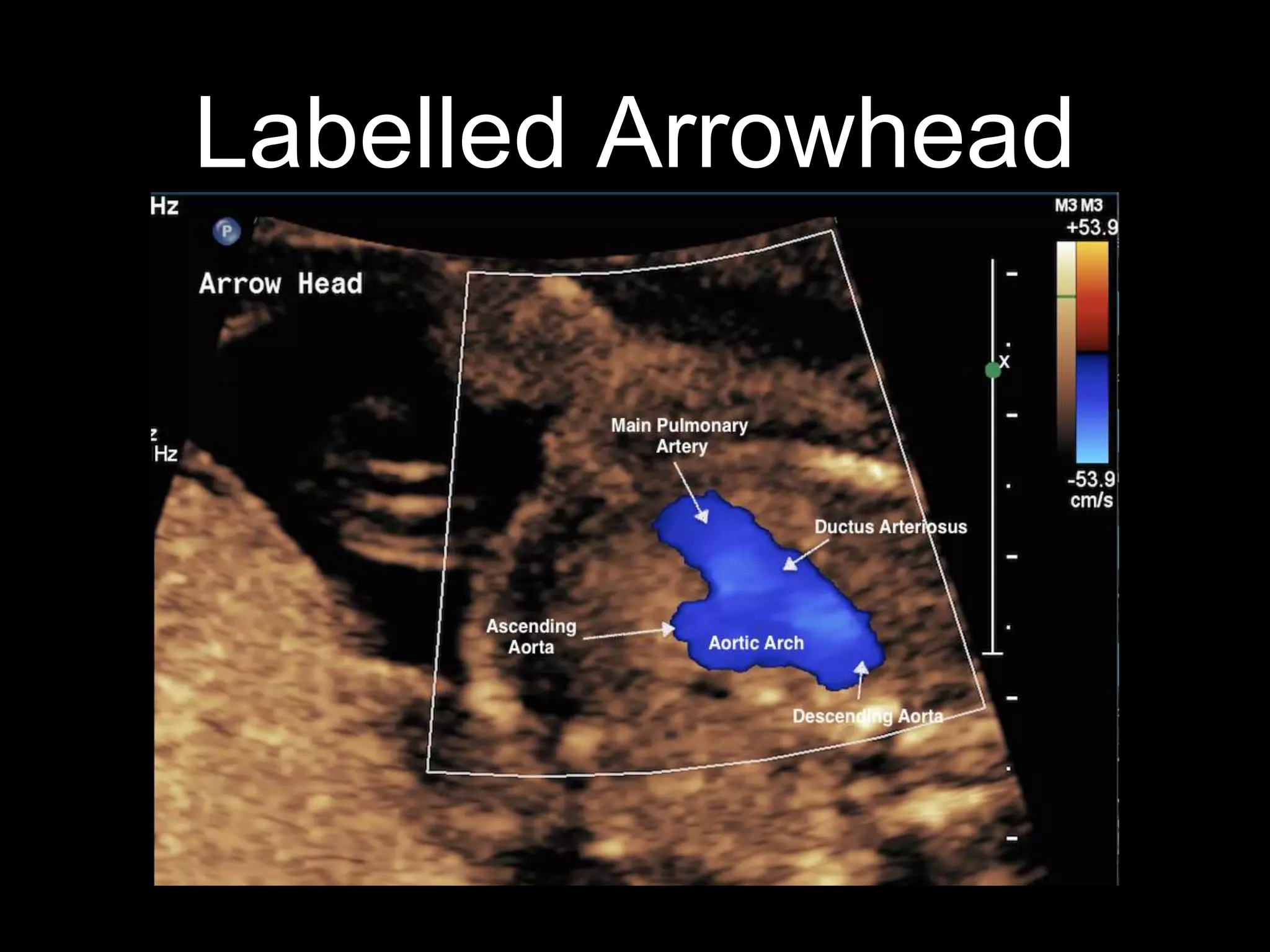 Labelled fetal heart ultrasound | PPTX