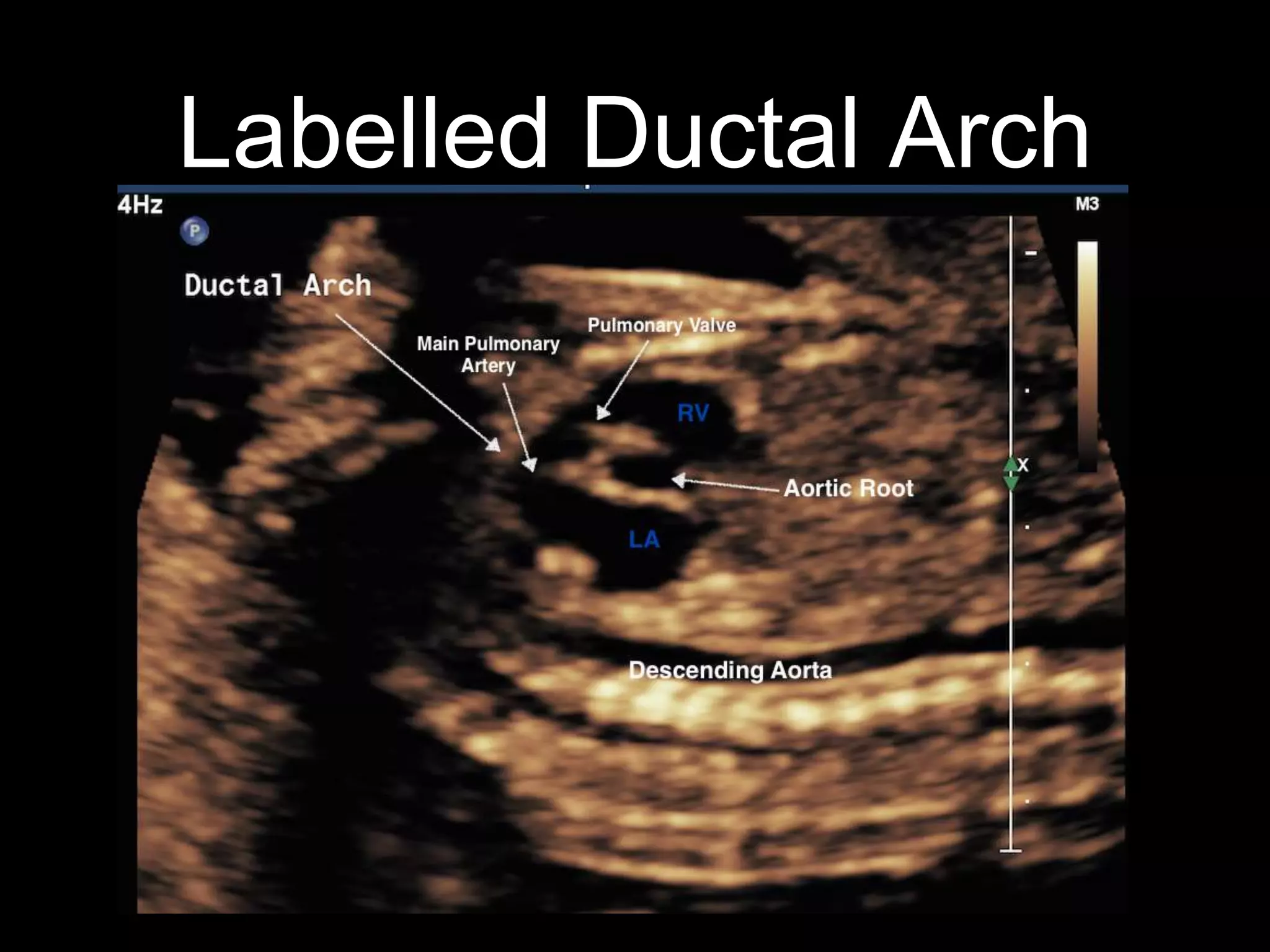 Labelled fetal heart ultrasound | PPTX