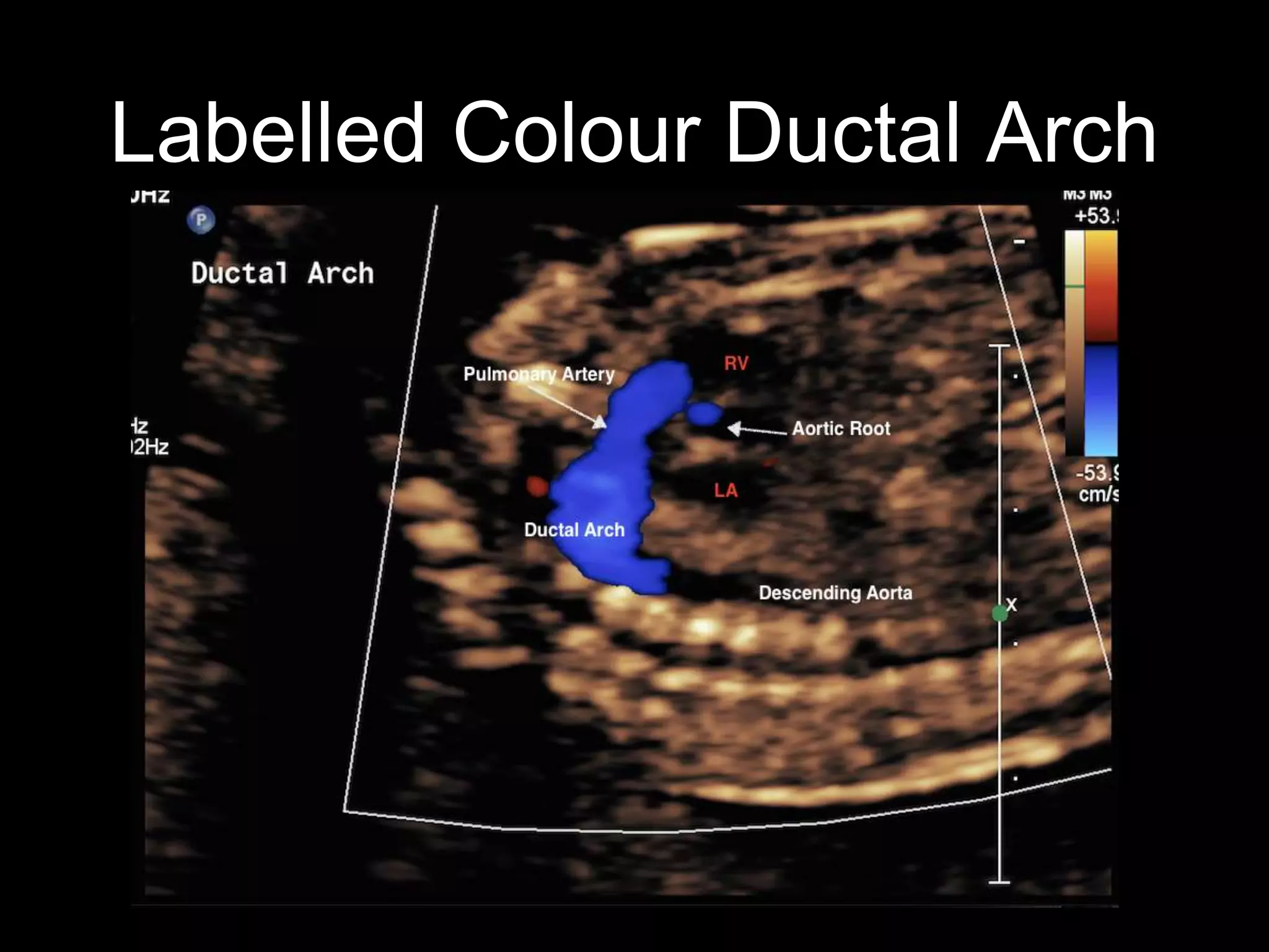 Labelled fetal heart ultrasound | PPTX
