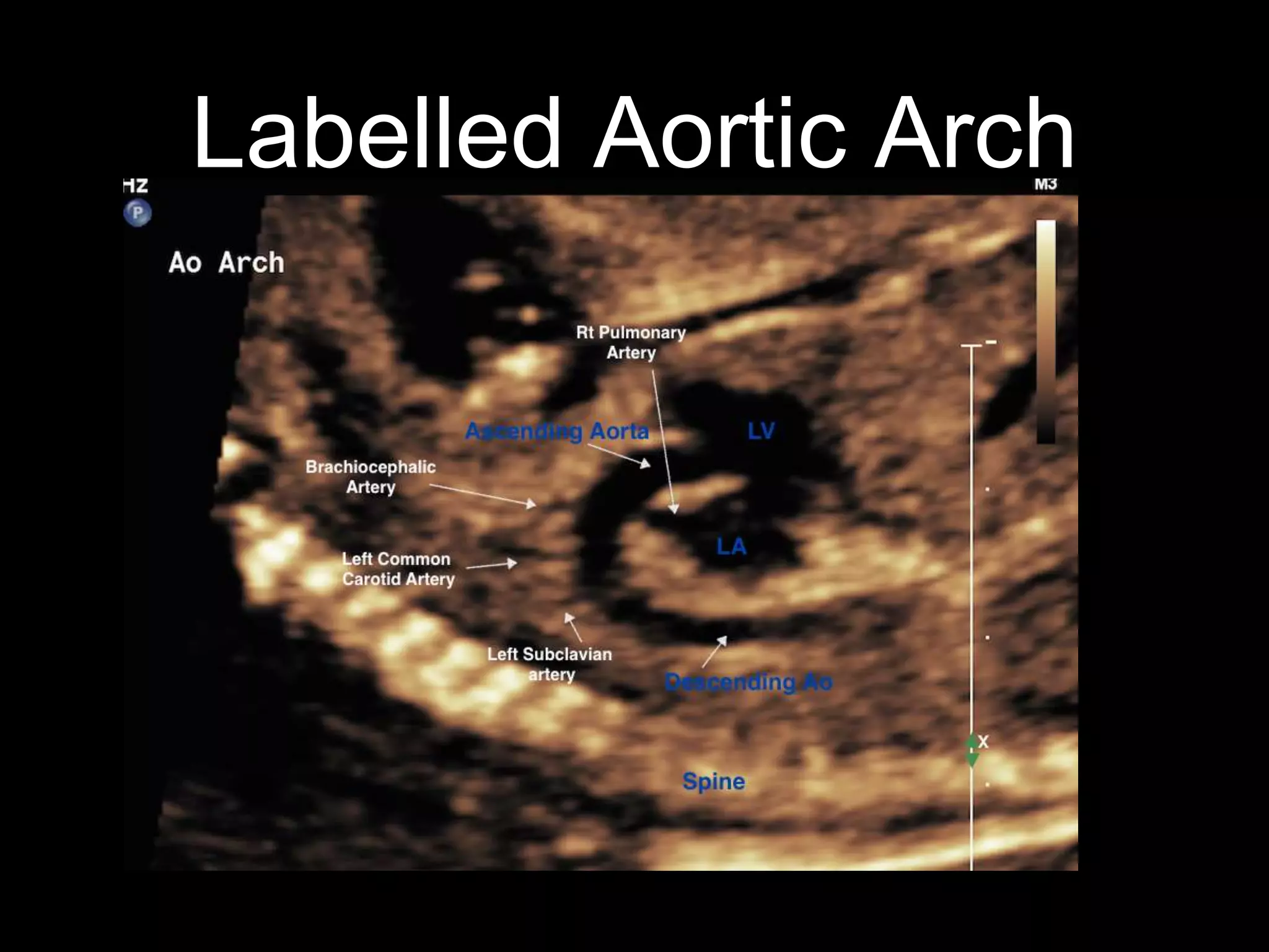Labelled fetal heart ultrasound | PPTX