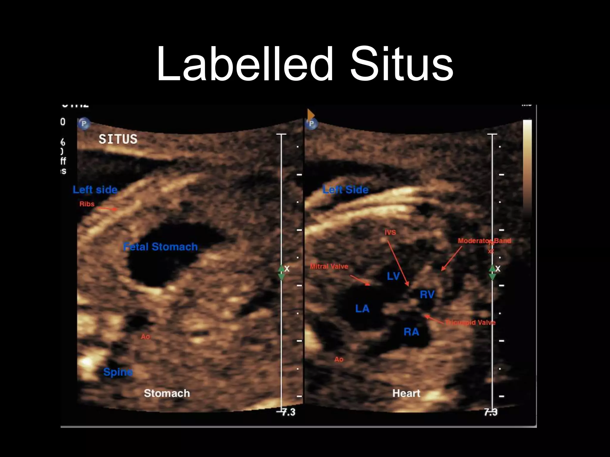 Labelled fetal heart ultrasound | PPTX